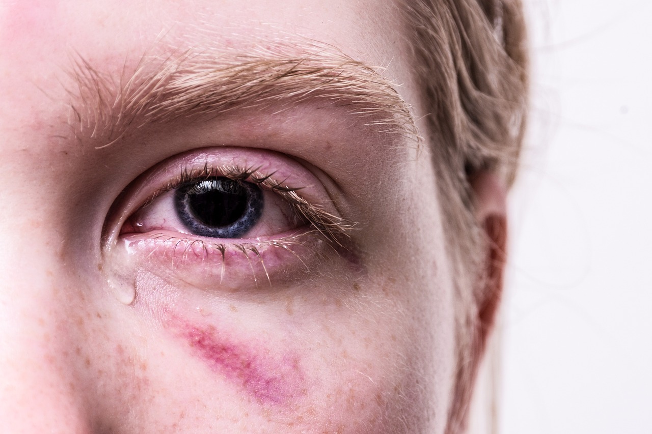 Eye Injury Lawyer in Kansas City | Vision Loss & Trauma Claims ...